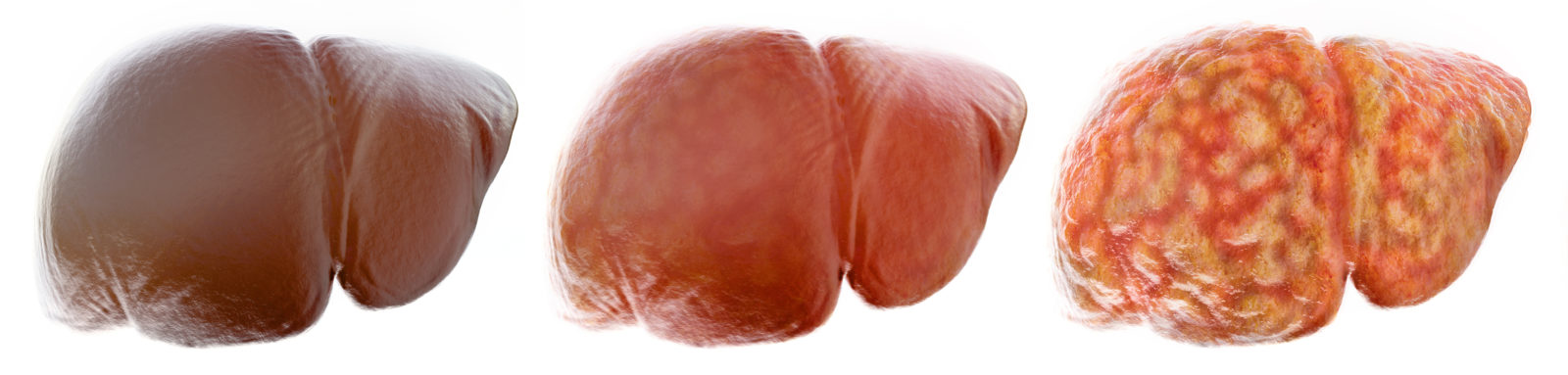 Why Fatty Liver is a Health Priority and How to Turn it Around